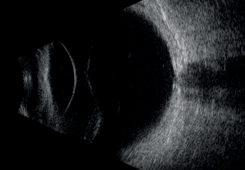 Quantel-medical-absolu | Laservision Instruments B.V.